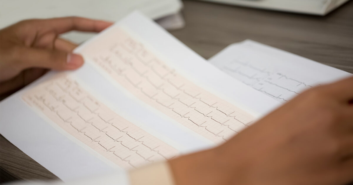 Understanding Premature Ventricular Contractions (PVCs) | Kardia