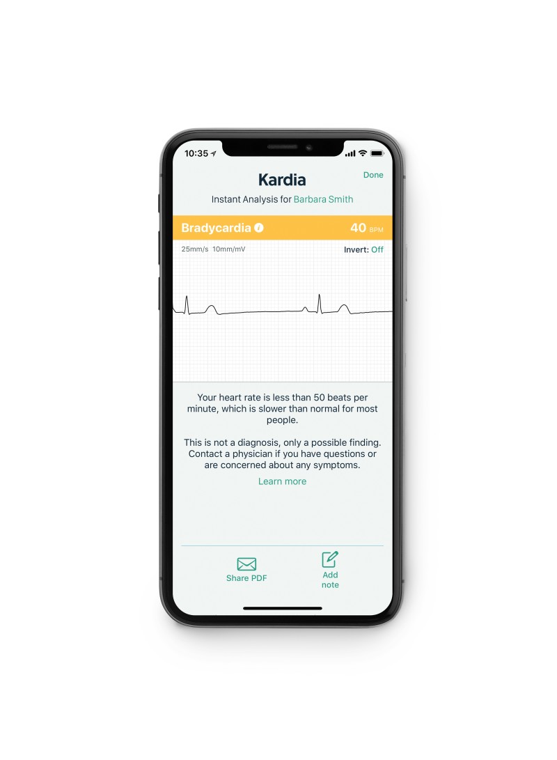 What is Bradycardia? | Kardia